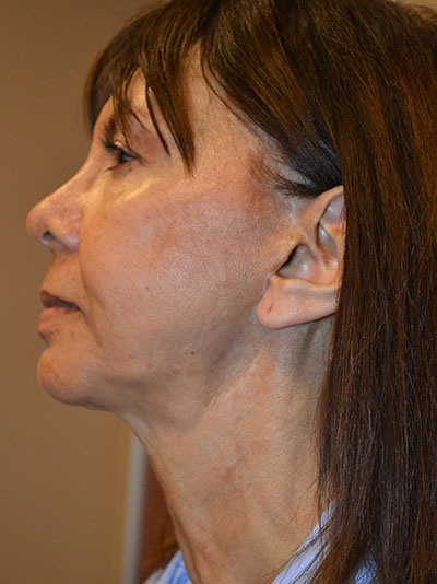Neck Lift Case 2651 | Facelift Cosmetic Surgery in Inland Empire